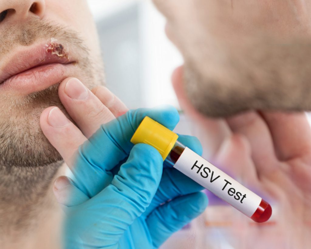 4 Common STIs That Cannot Be Prevented by Condoms: What You Need to ...